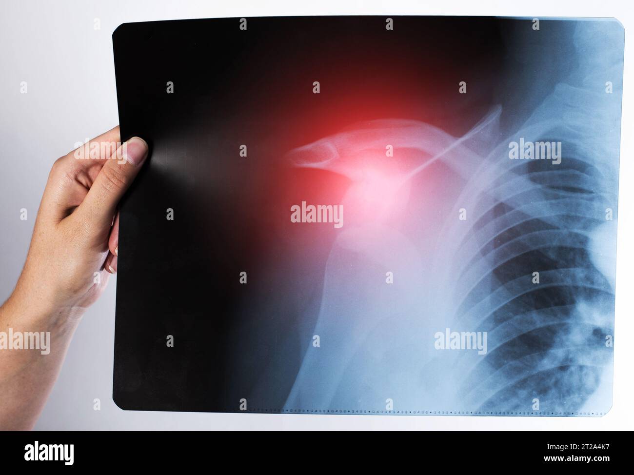 The doctor holds in his hand an x-ray of a dislocated shoulder joint ...
