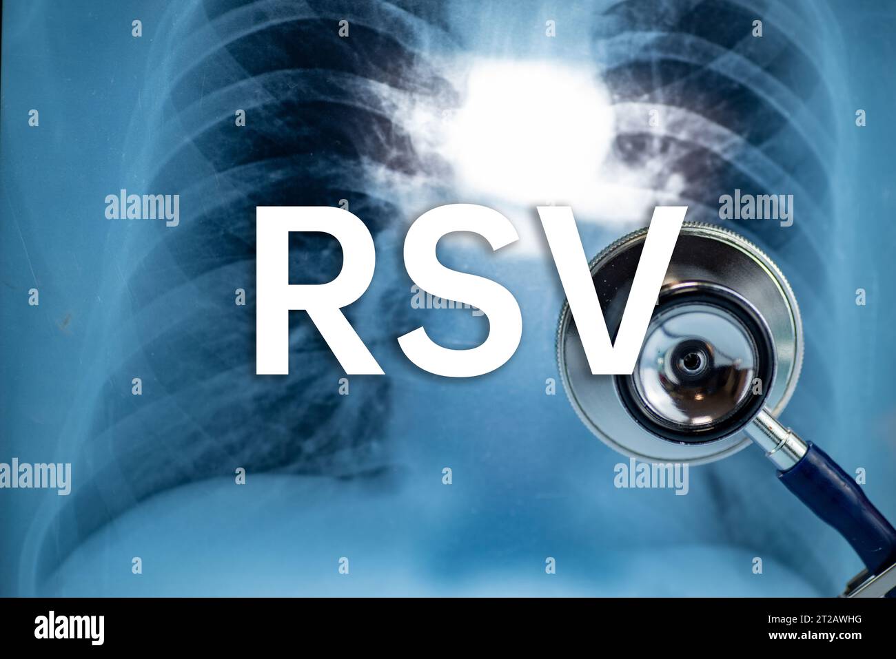 Background of Respiratory syncytial virus(RSV) and chest X-ray,medical ...