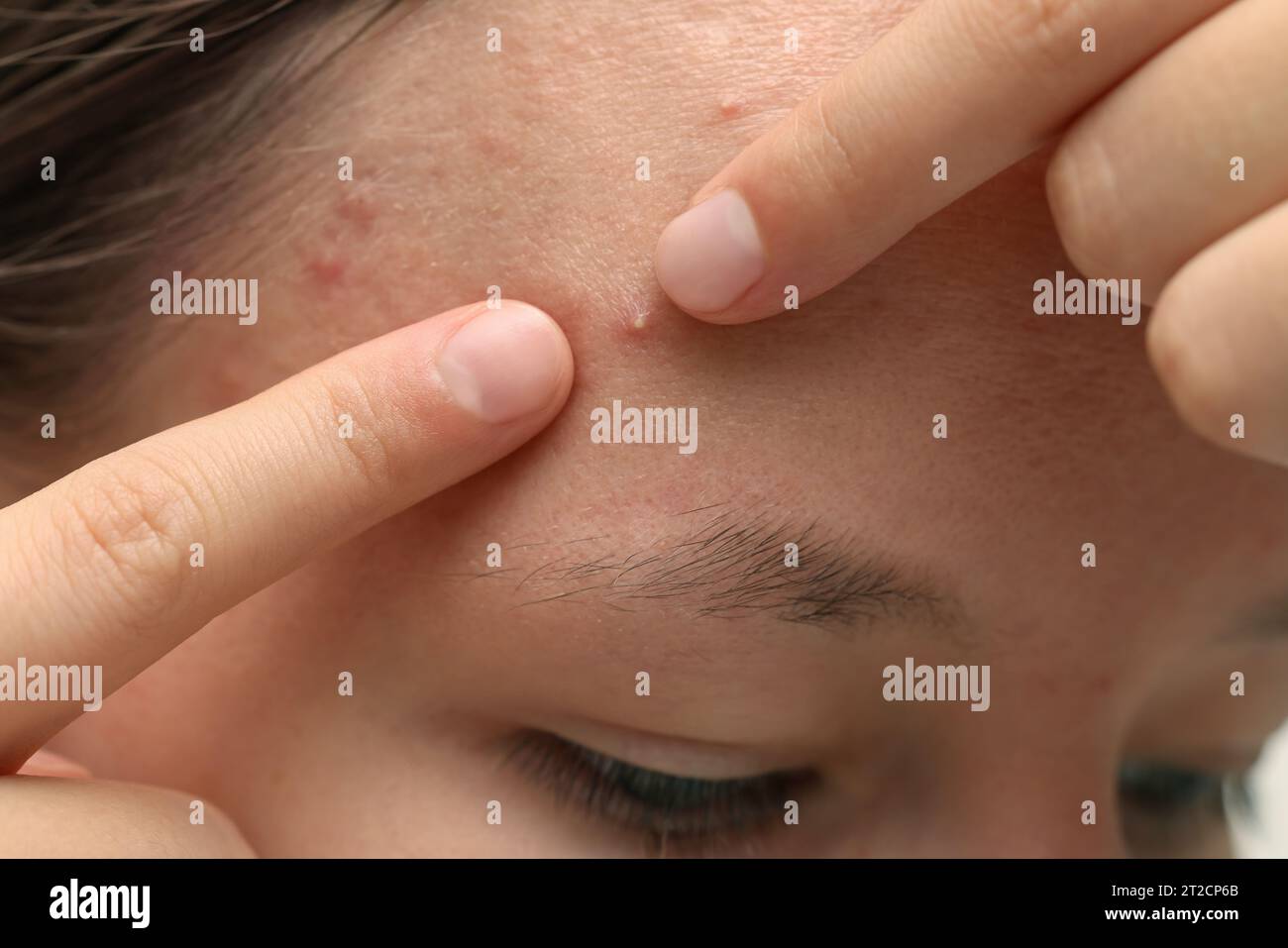 Woman touching spot on face hi-res stock photography and images - Alamy