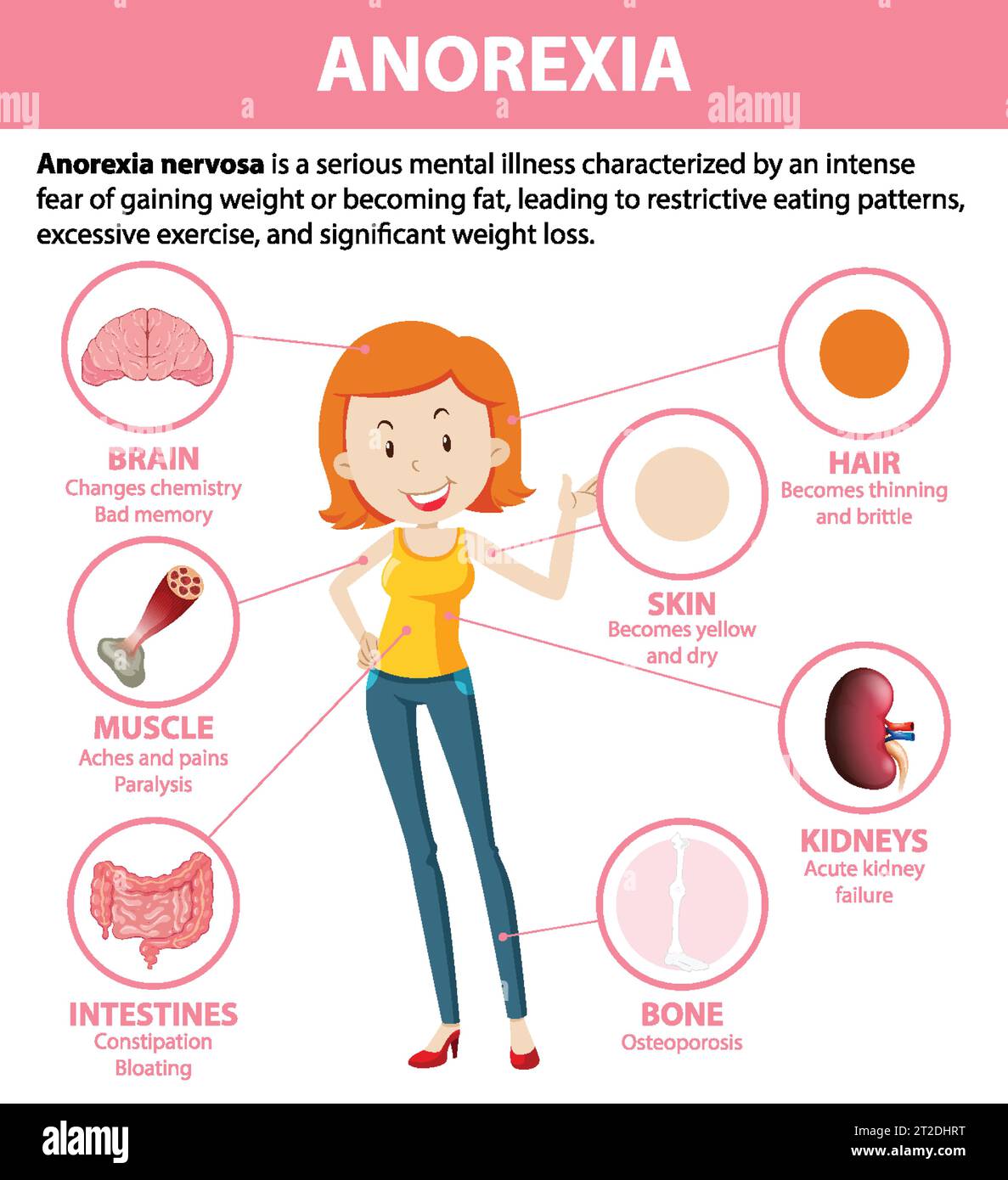 Illustration depicting the impact of Anorexia on various body functions Stock Vector Image & Art ...