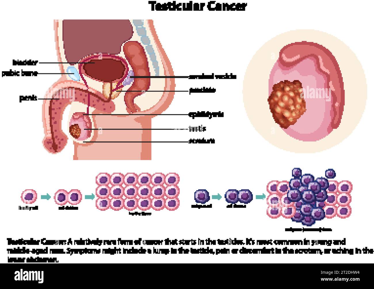 Illustration Of Male Anatomy With Testicular Cancer Stock Vector Image