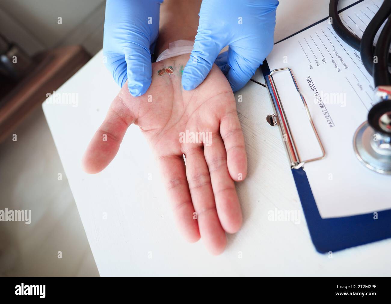 The doctor examines the healing wound of the patient on the hand palm ...