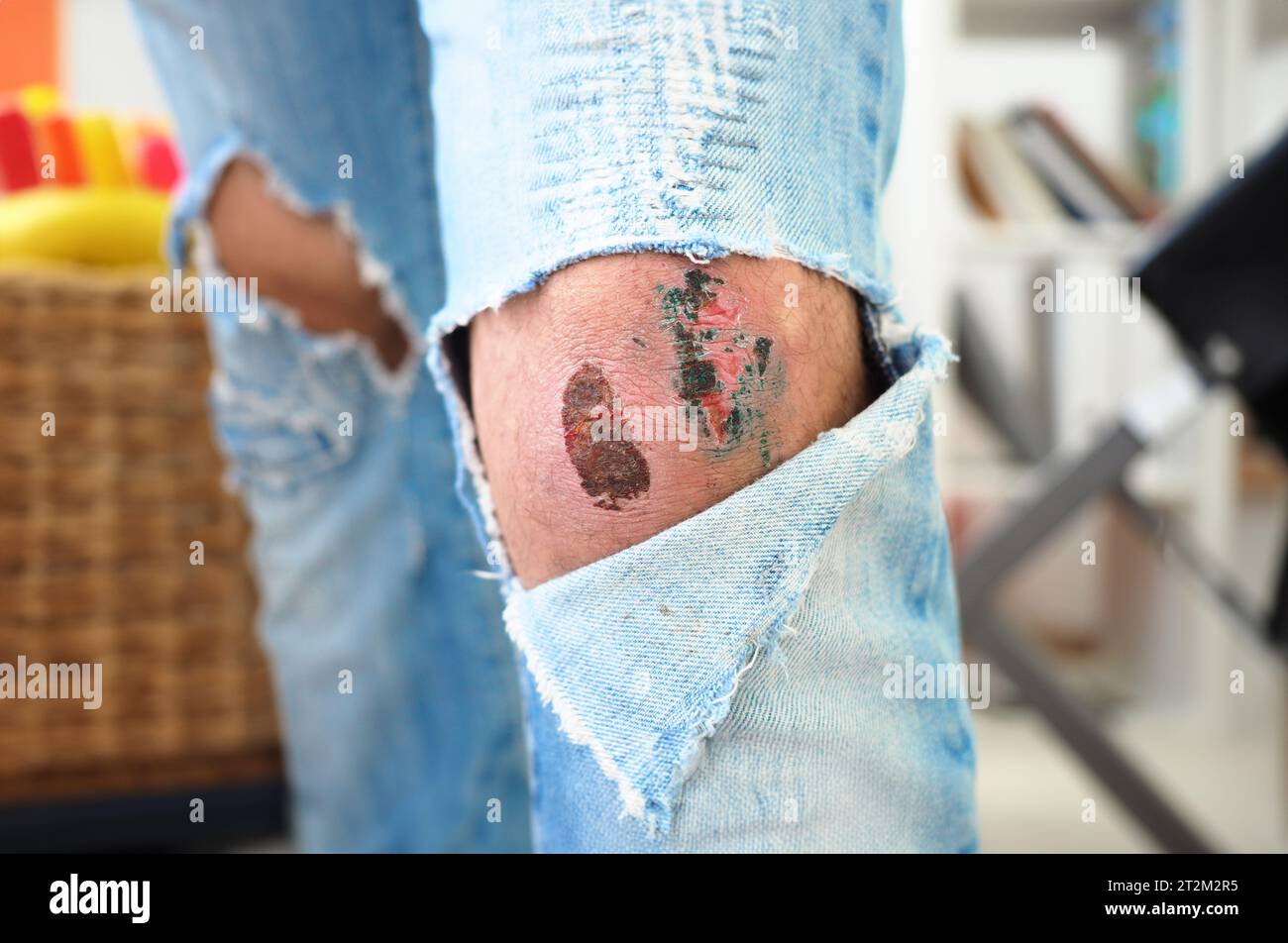 Wound on the knee torn jeans pants Stock Photo - Alamy