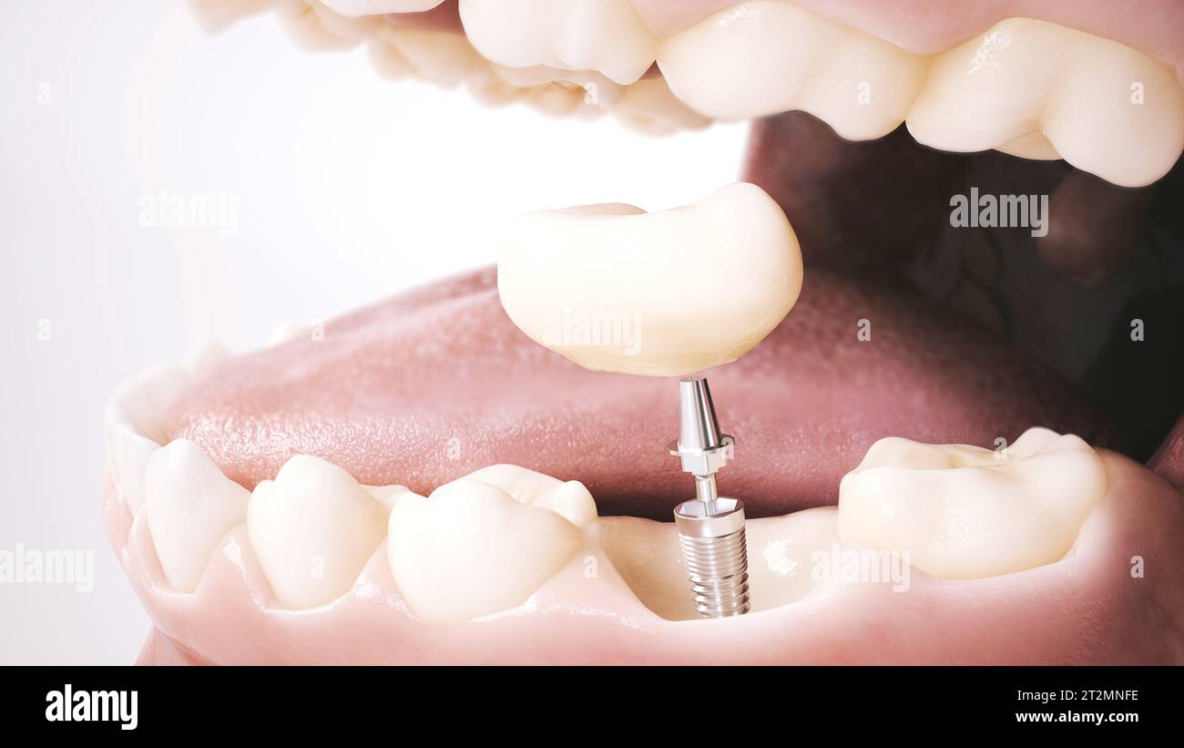 First Step to the Perfect Smile: Filling the Gap with an Implant. Part ...