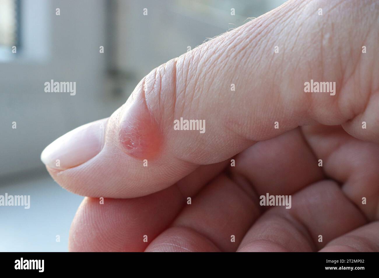 Hygroma (Ganglion cyst) of the thumb joint. Selective focus Stock Photo ...