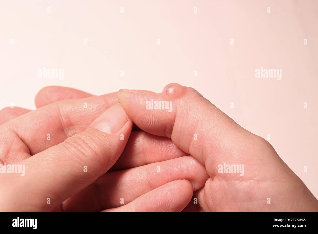 Female hand with hygroma of the thumb. Selective focus Stock Photo - Alamy