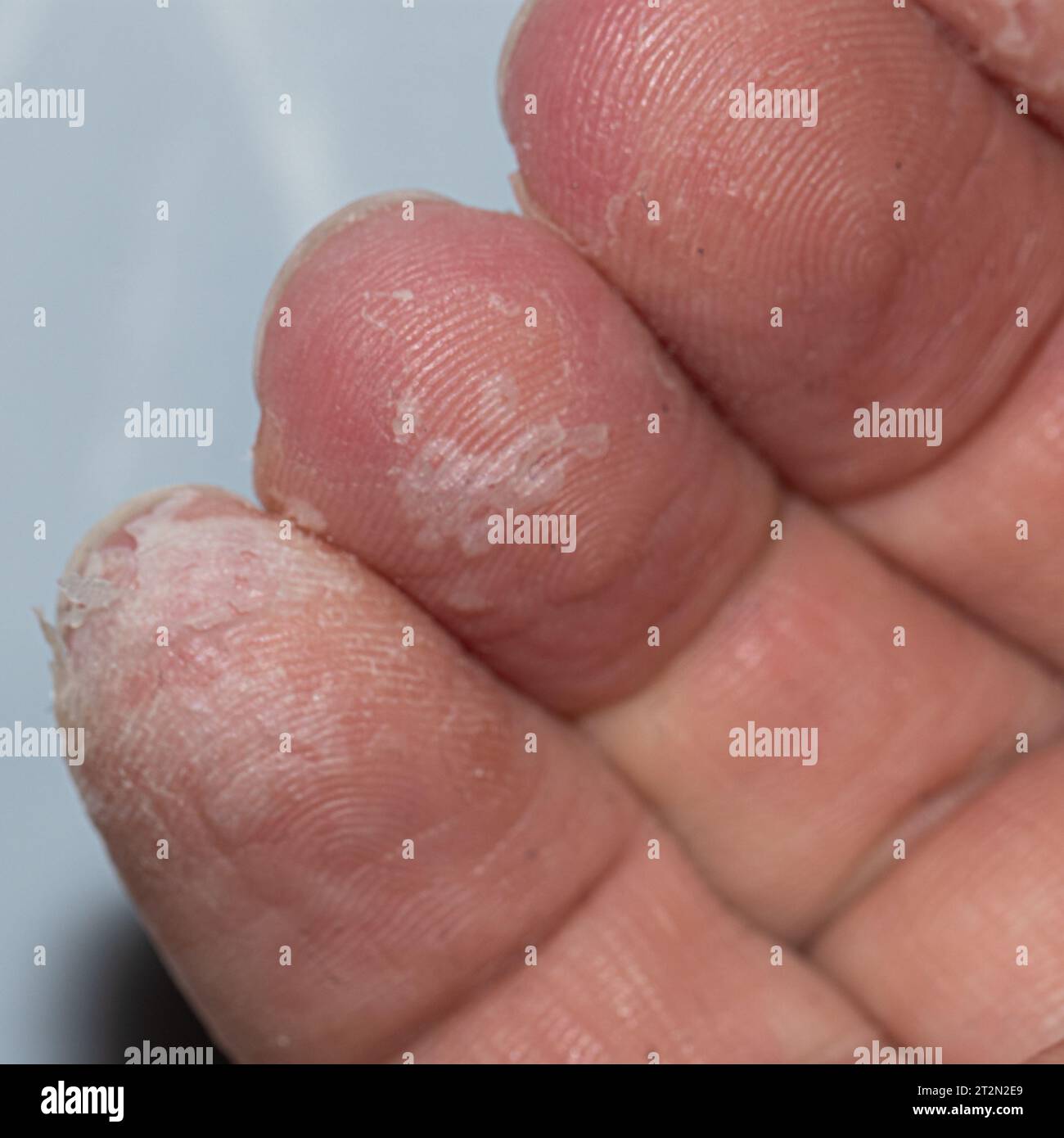 Close-up of a Caucasian hand with skin peeling due to the effects of ...