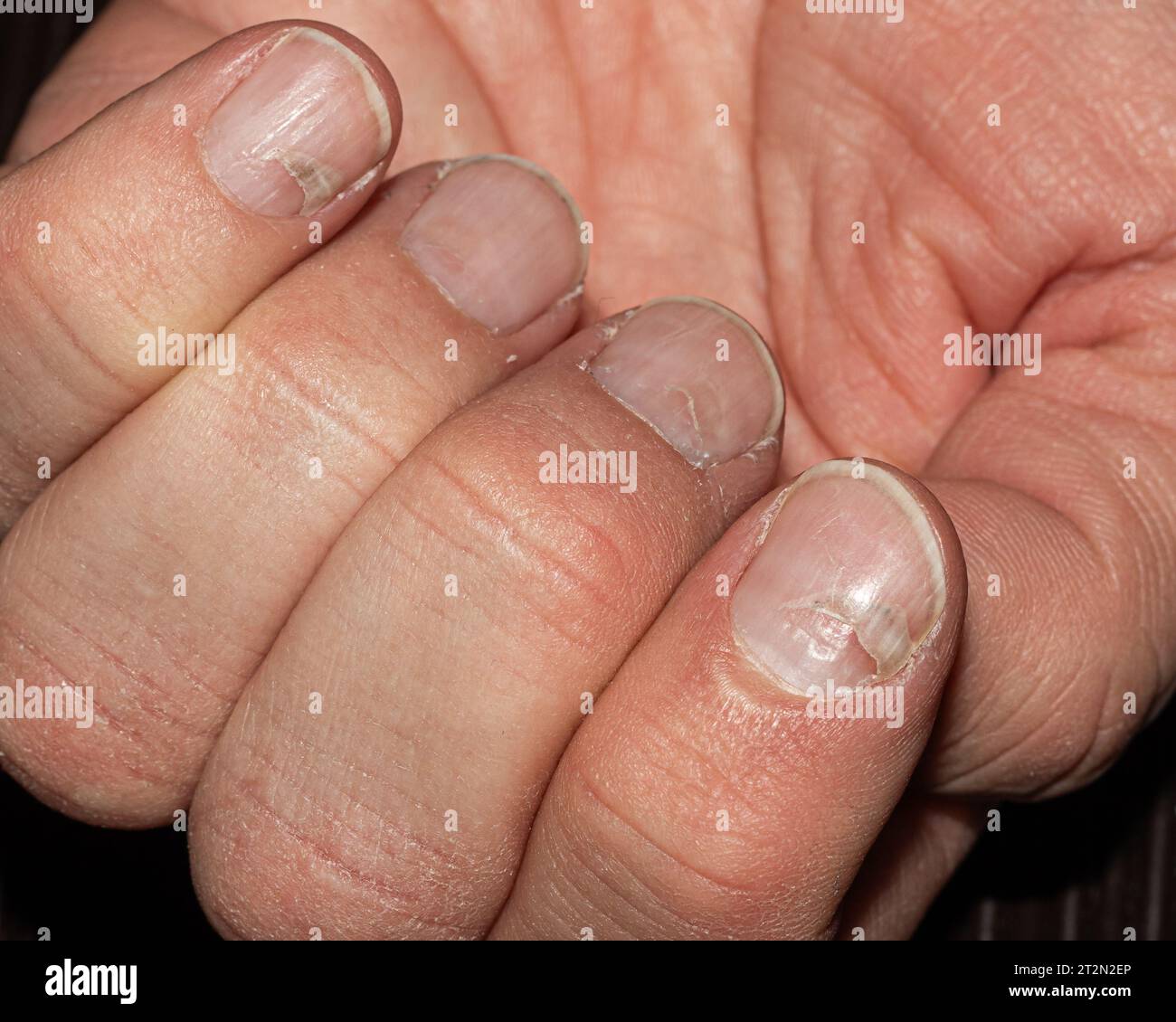 The recovery process of a Caucasian hand after scarlet fever ...