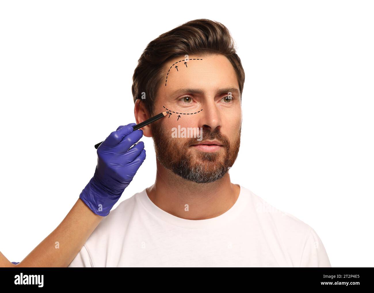 Man preparing for cosmetic surgery, white background. Doctor drawing ...