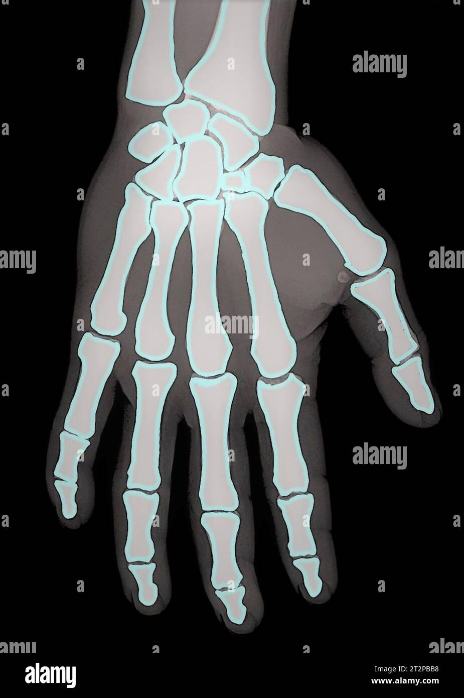 Healthy hand, X-ray Stock Photo - Alamy