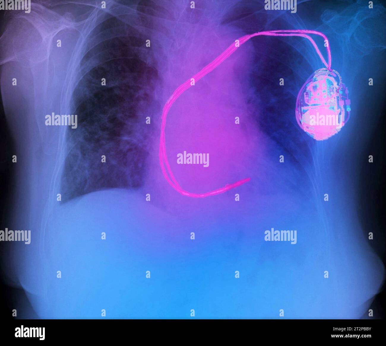 Chest x ray colored hi-res stock photography and images - Alamy
