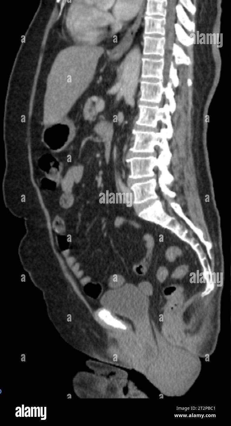 Uterine prolapse hi-res stock photography and images - Alamy