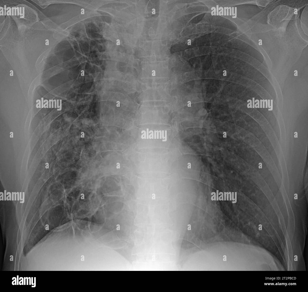 Bronchiectasis hi-res stock photography and images - Alamy