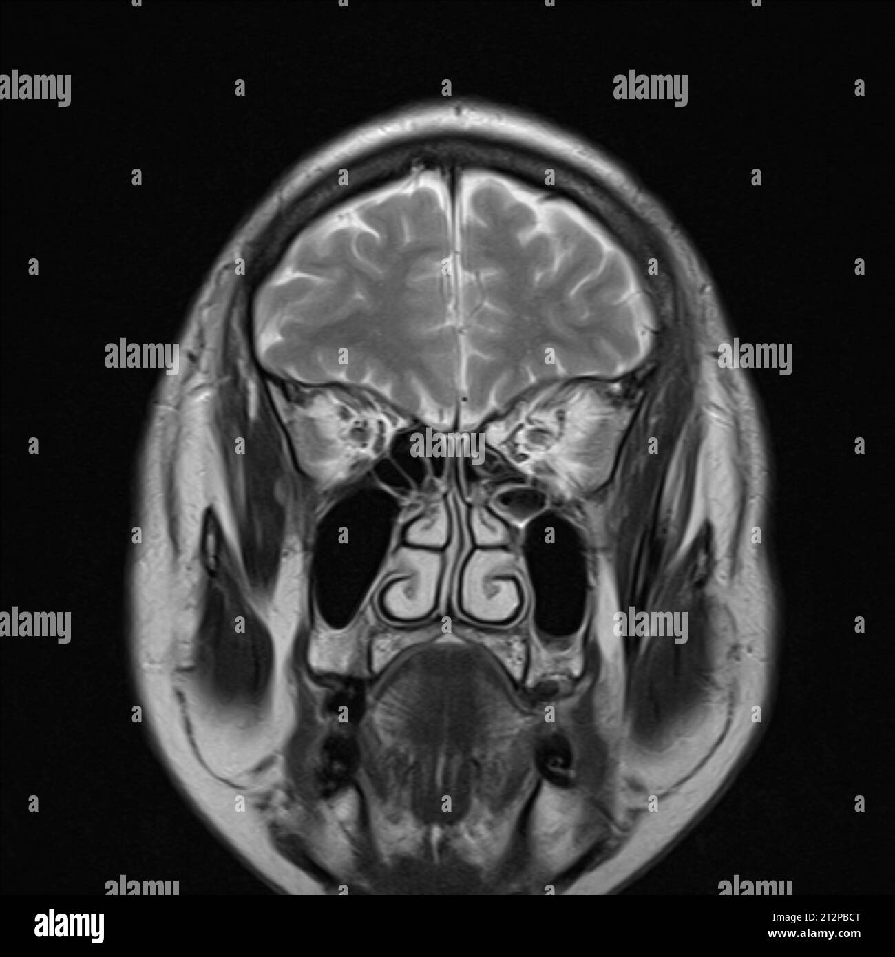 Normal Brain Mri Labeled