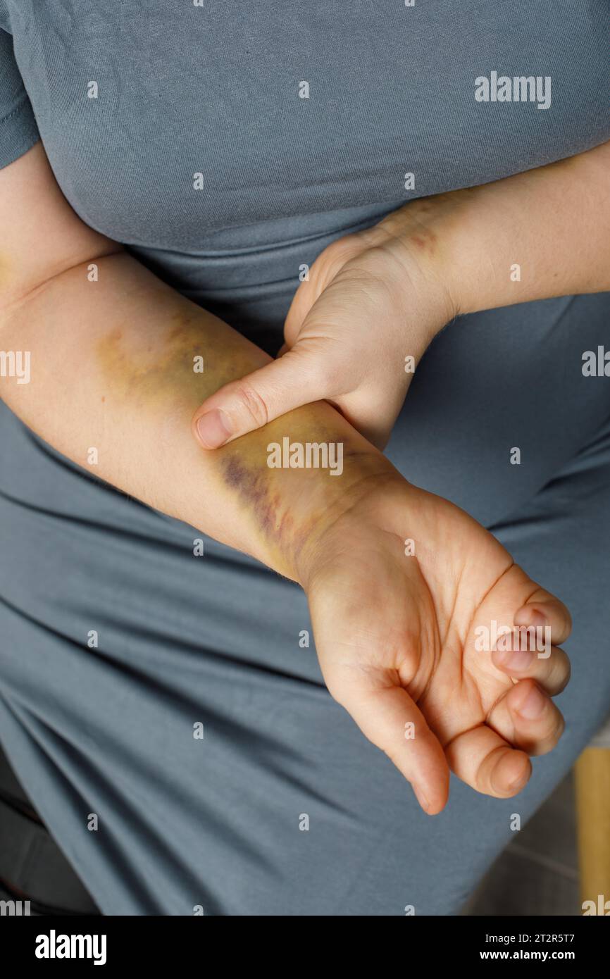 Moman supporting an arm with a significant bruise Stock Photo - Alamy