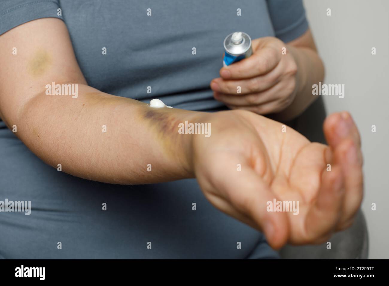Aid for bruising. Large hematoma bruise on the arm, ointment and white ...