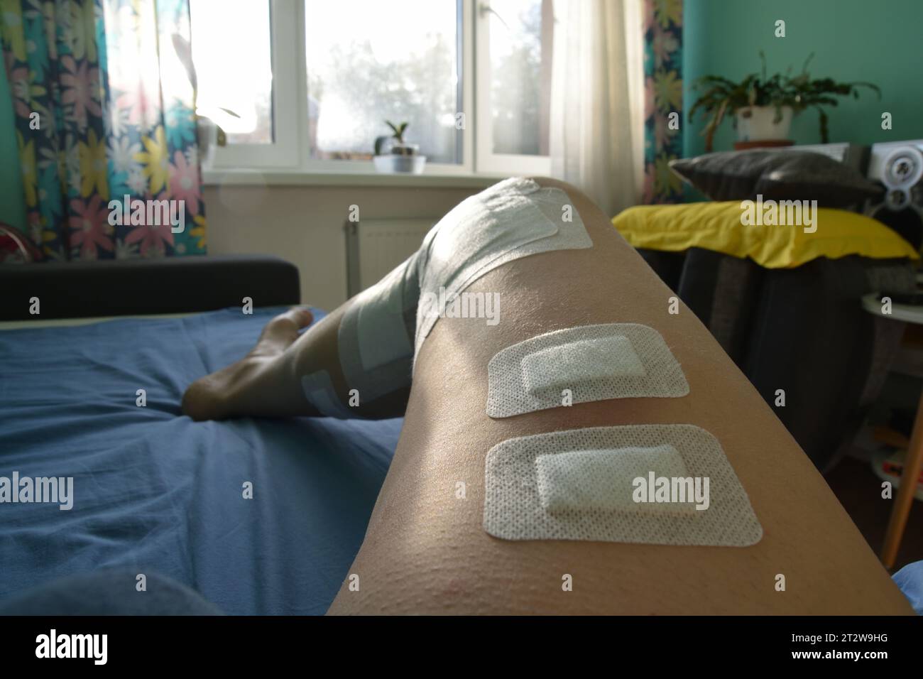 Recovering at home after vein laser surgery on the legs. Close-up of a ...