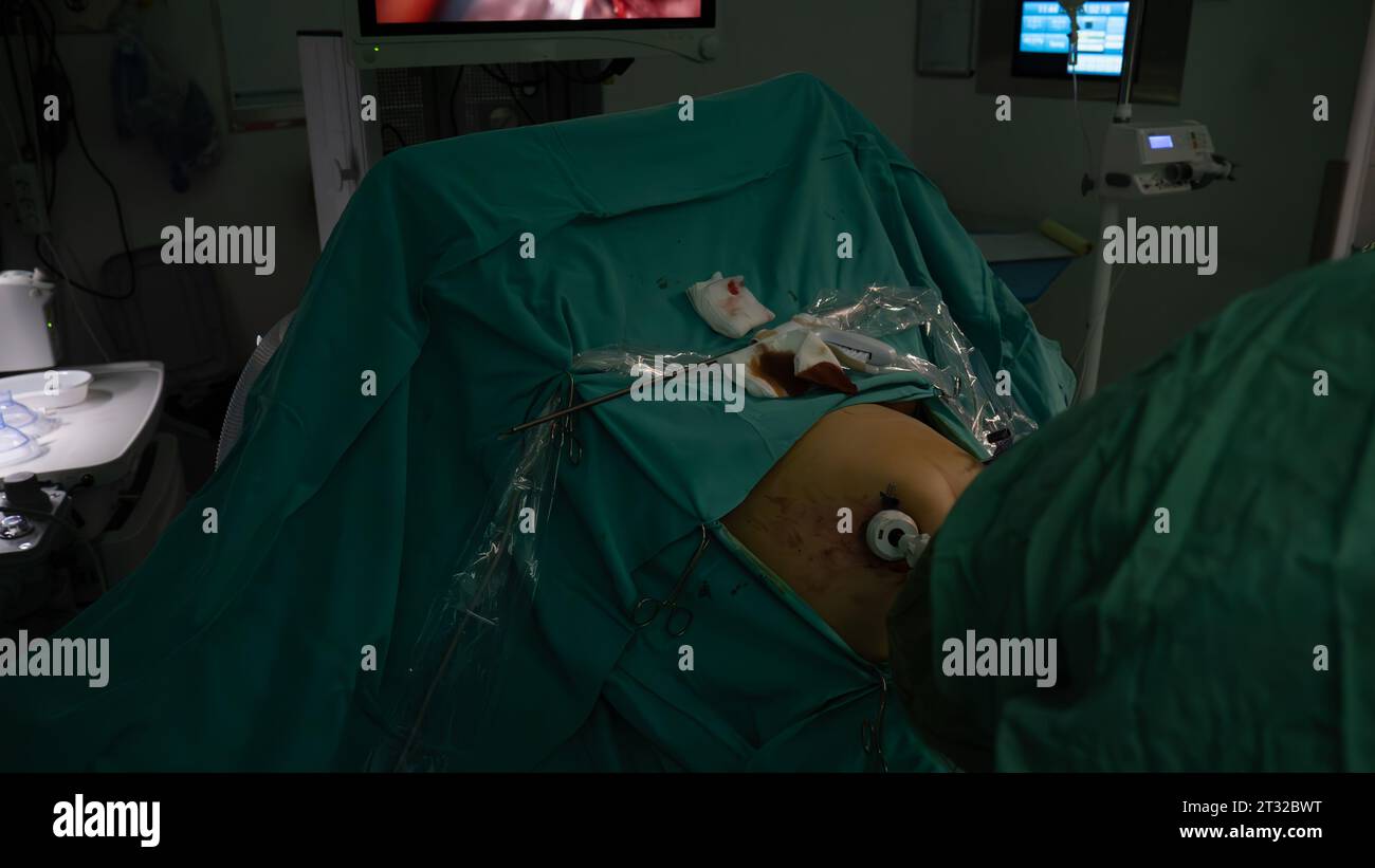 Obesity surgery. Weight loss surgery is performed with laparoscopic ...