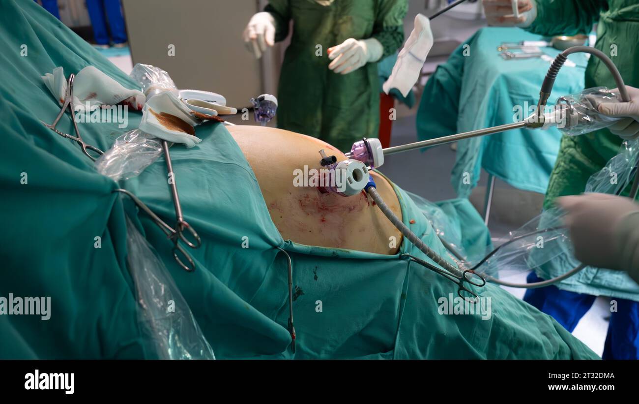 Obesity surgery. Weight loss surgery is performed with laparoscopic ...