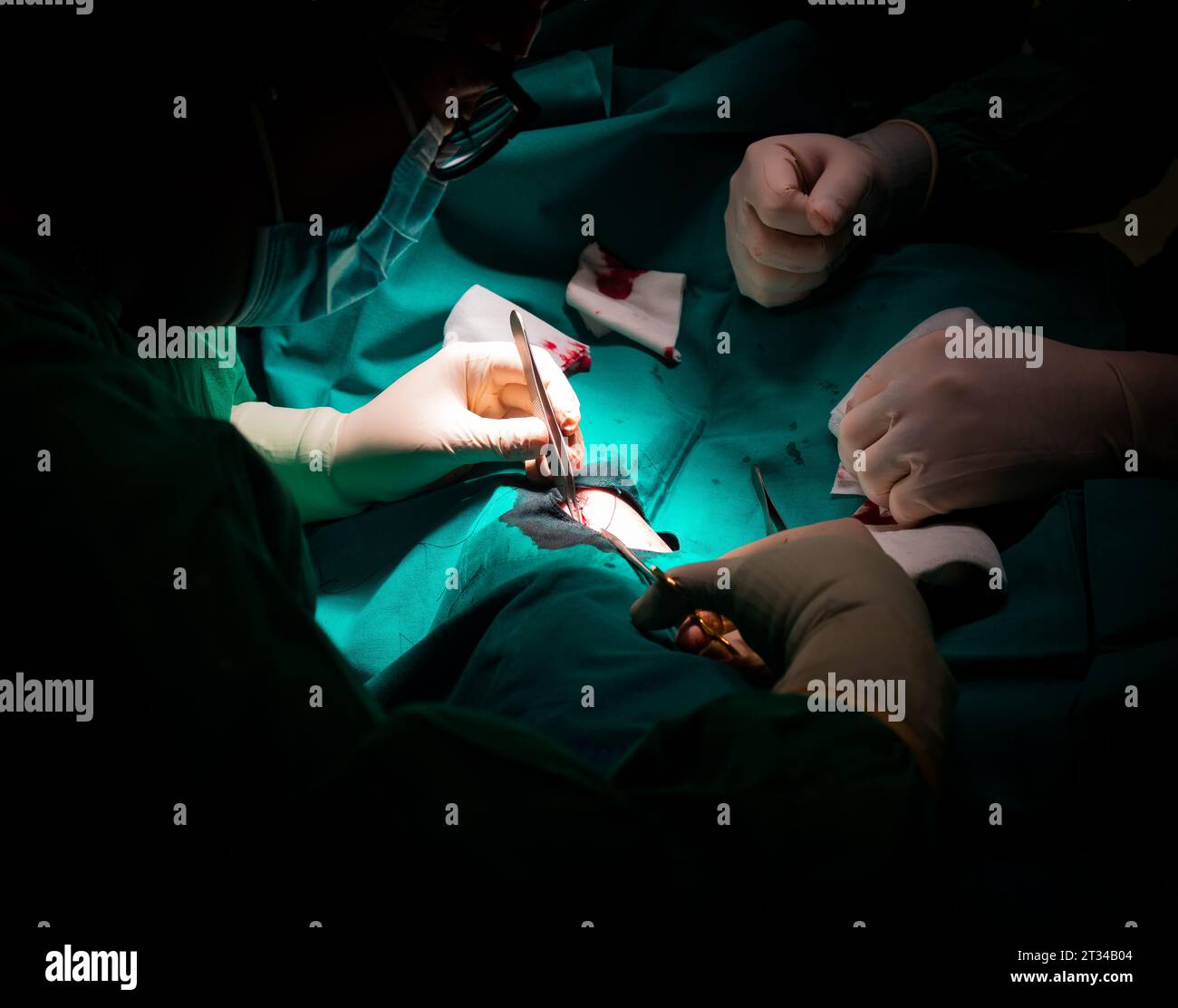 Close-up of a surgeon's hands stitching a patient's skin incision Stock ...