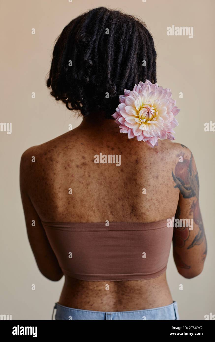 Acne top hi-res stock photography and images - Alamy