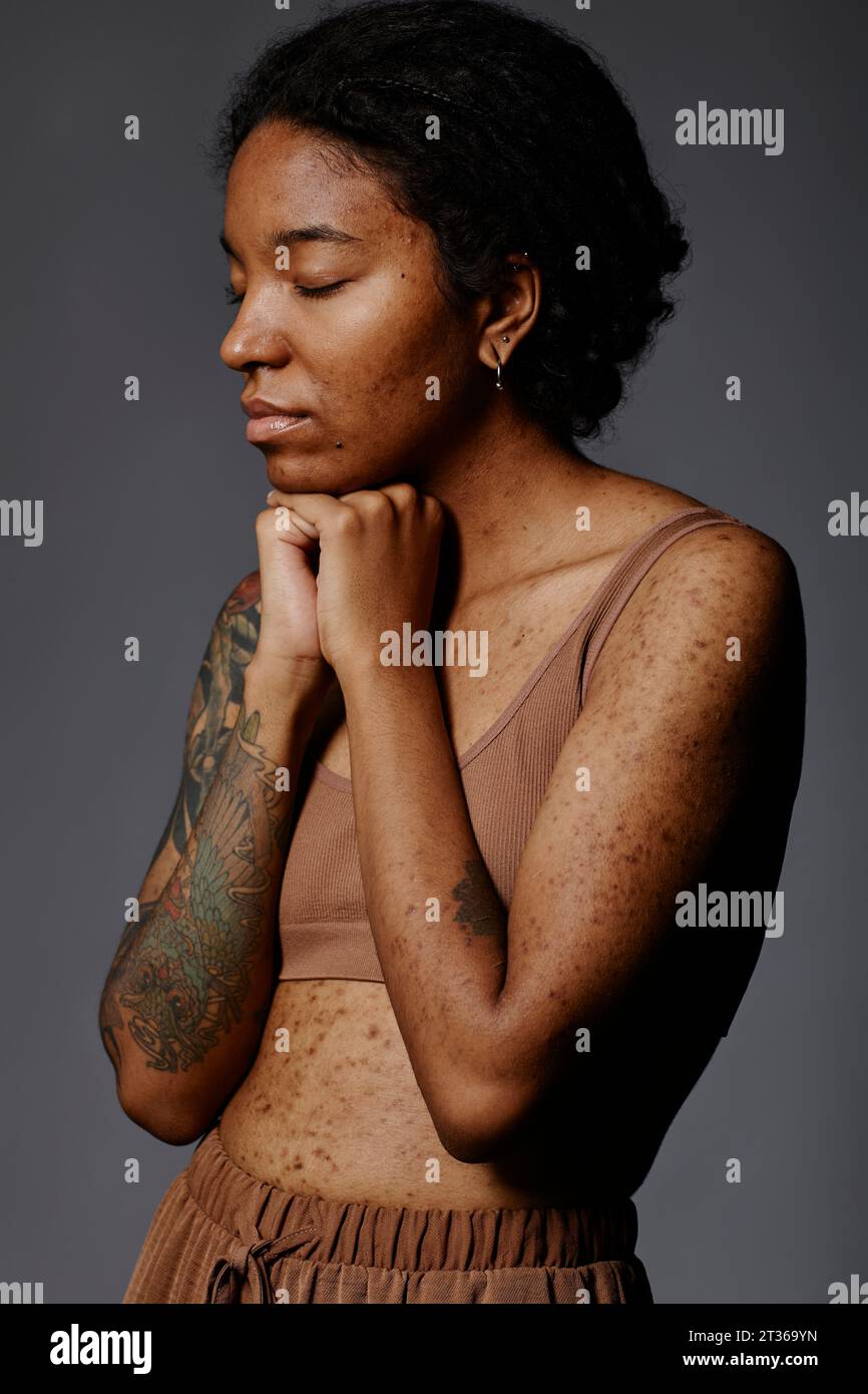 Young woman with acne scars and tattoo standing against gray background ...
