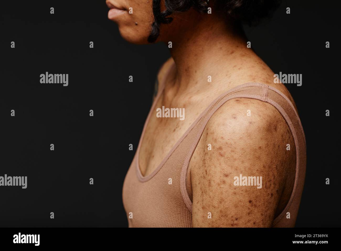 Acne black woman hi-res stock photography and images - Alamy