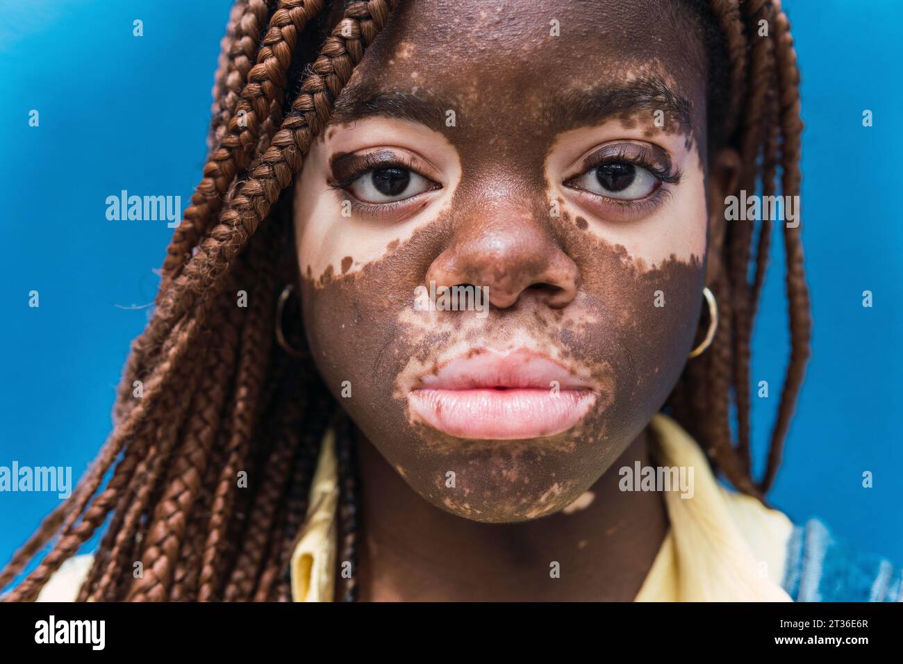 Young woman with depigmentation on face against blue background Stock ...