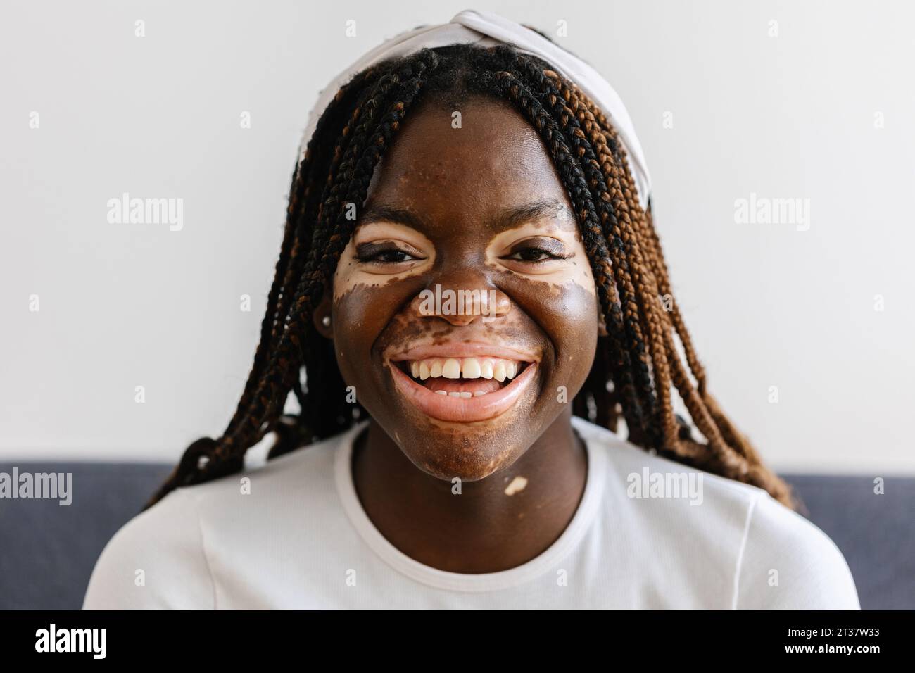 Happy young woman with vitiligo smile at camera sitting on sofa Stock ...