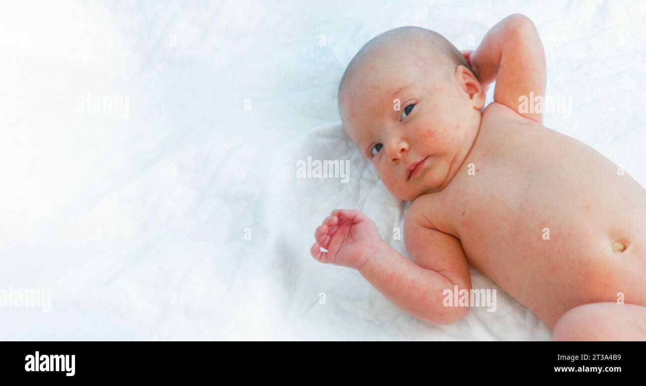 Miliaria baby hi-res stock photography and images - Alamy