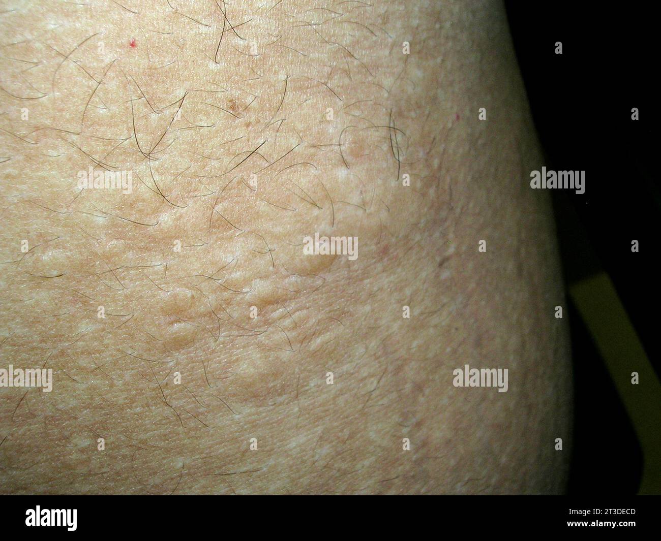 Shagreen patch in tuberous sclerosis Stock Photo - Alamy