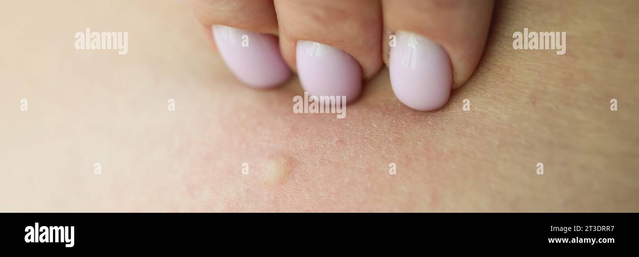 Female hand touches skin with rash examining eczema Stock Photo - Alamy
