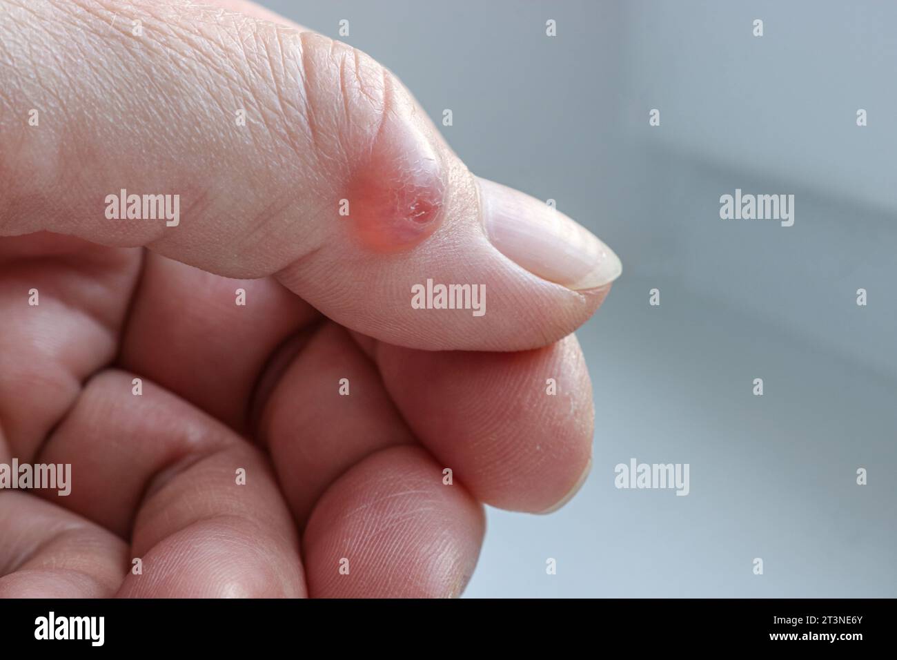 Ganglion cyst (synovial cyst disease) on the thumb of a woman’s hand ...