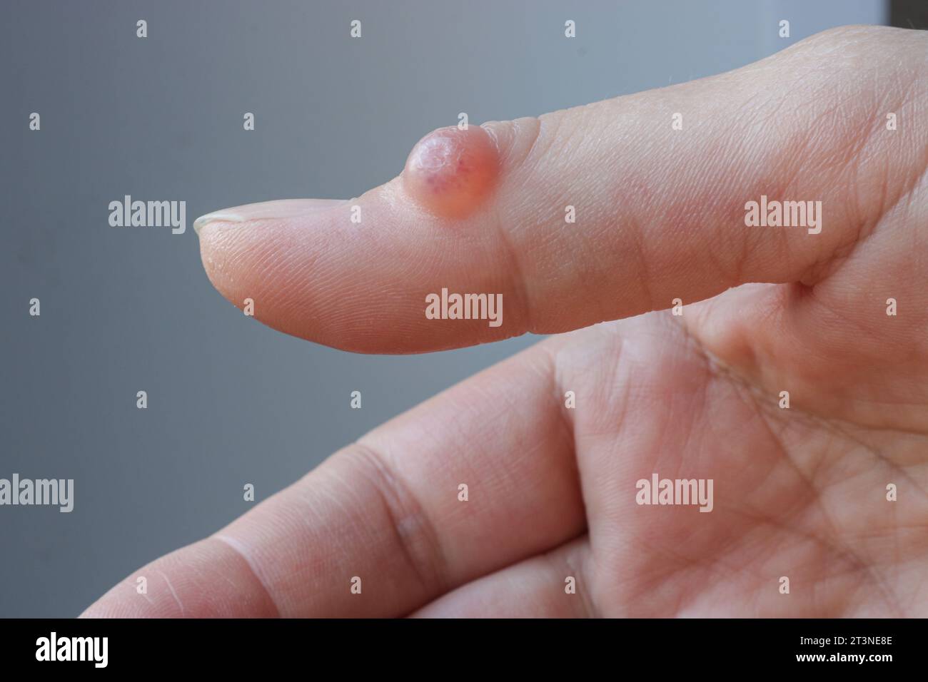Female hand with hygroma of the thumb. Selective focus Stock Photo - Alamy