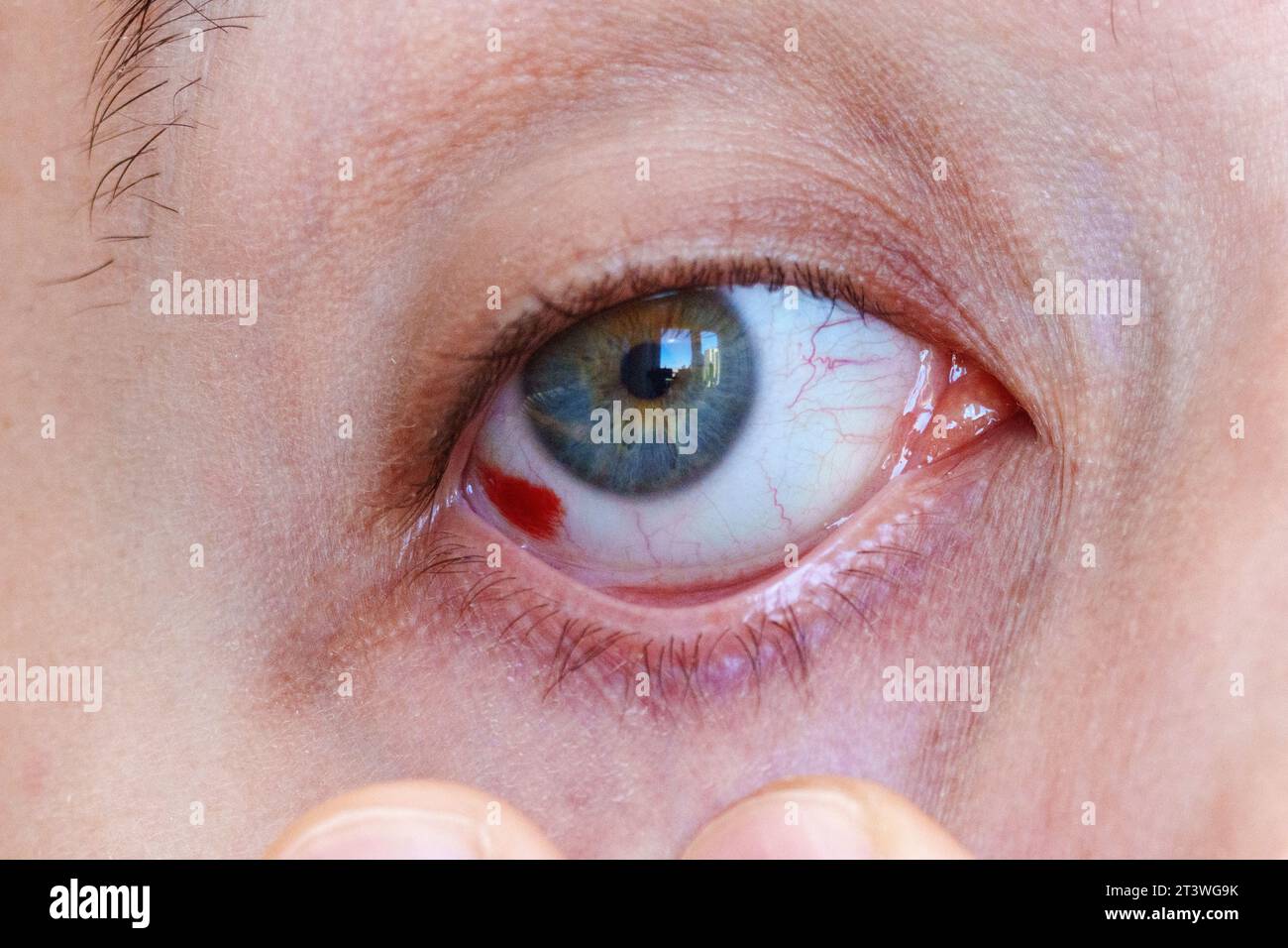 Bloodshot eye hi-res stock photography and images - Alamy