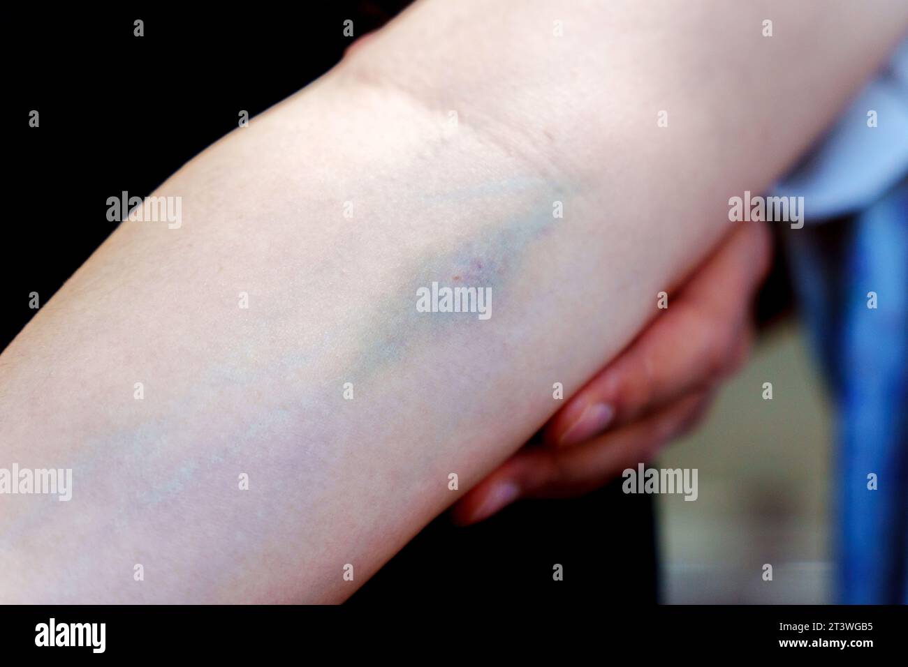 Injection marks hi-res stock photography and images - Alamy