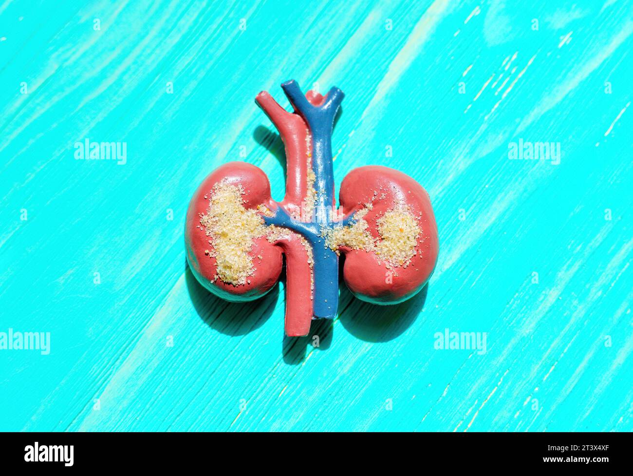 Anatomical model depicting human kidneys with sand-like particles ...