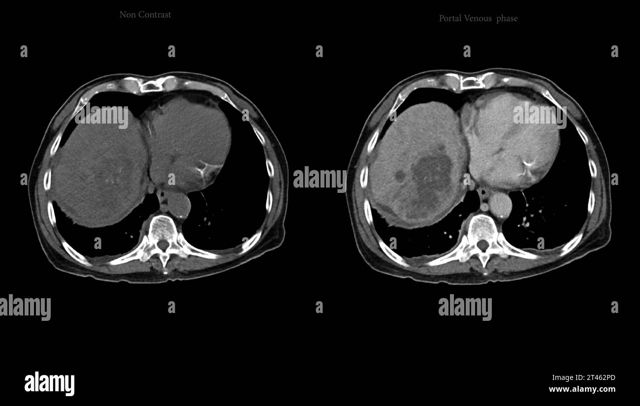 CT upper abdomen axial view NC, A phase , V phase and delayed phase DDX ... CT upper abdomen axial view NC, A phase , V phase and delayed phase DDX ...