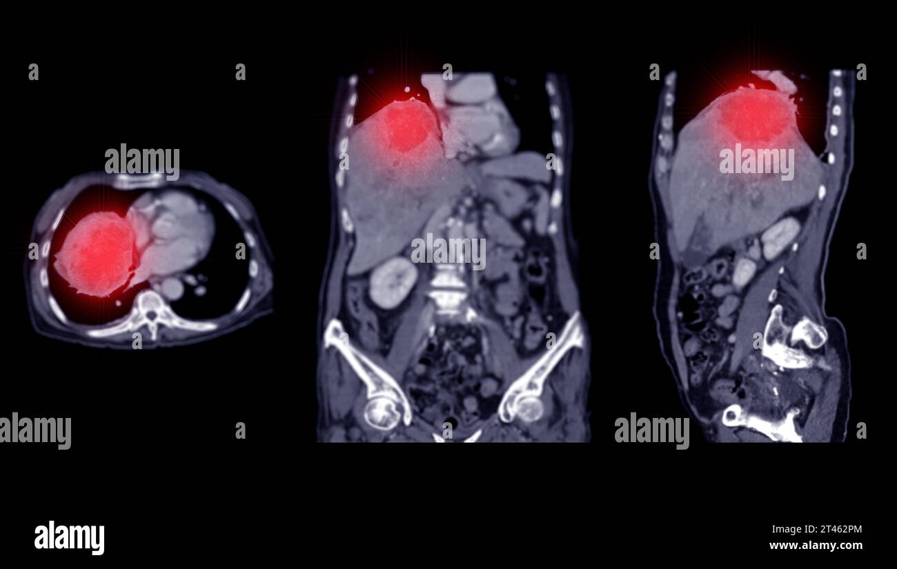 CT upper abdomen DDX is atypical HCC or hepatocellular carcinoma Stock ...