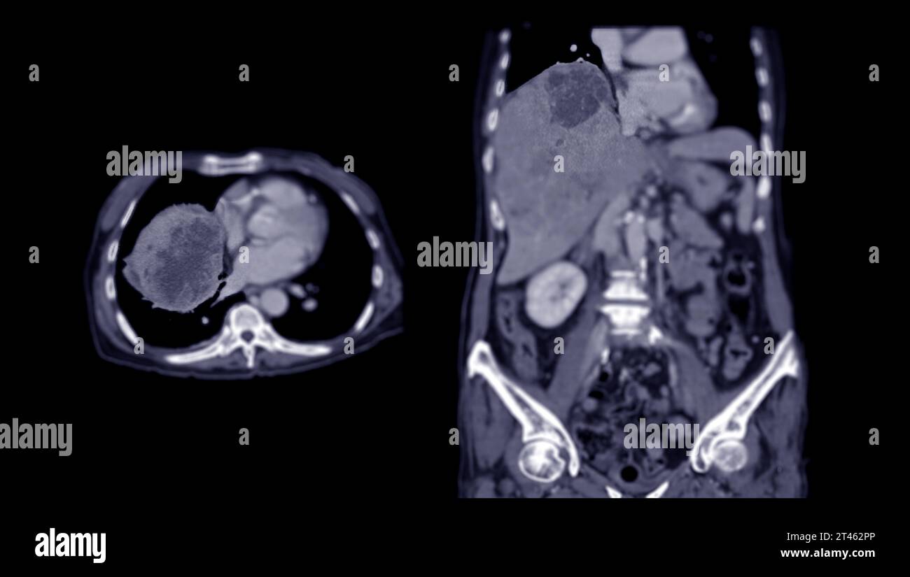 CT upper abdomen DDX is atypical HCC or hepatocellular carcinoma Stock ...