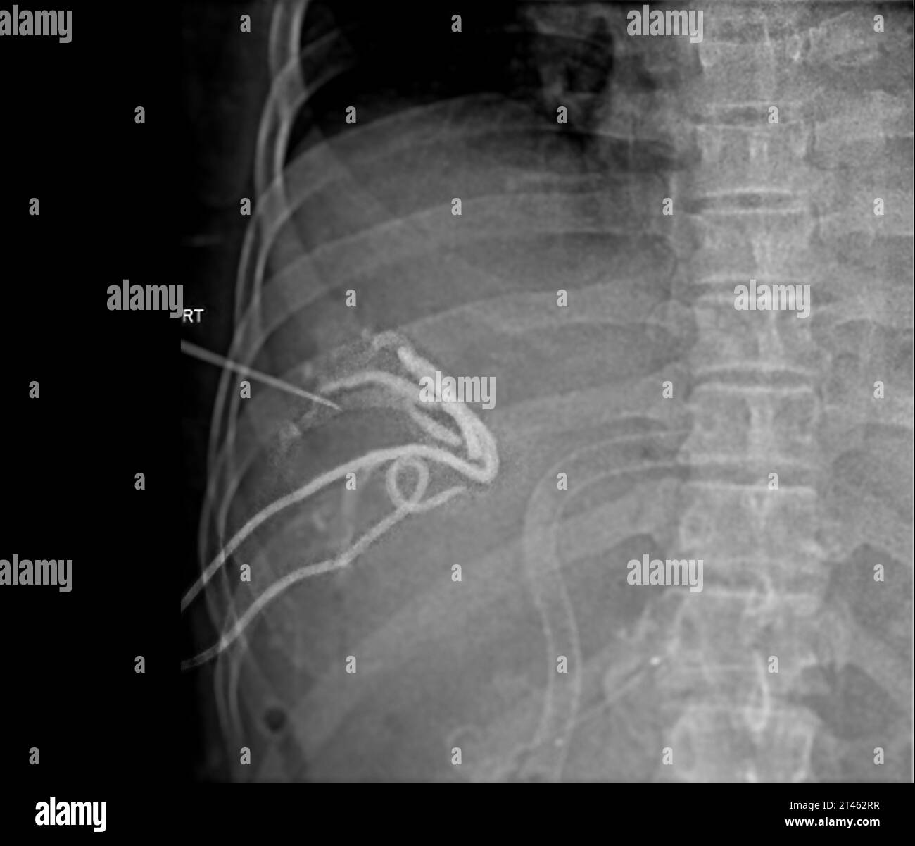 Percutaneous Transhepatic Biliary Drainage (PTBD) is a medical ...