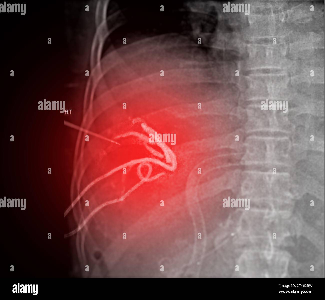 Percutaneous Transhepatic Biliary Drainage (PTBD) is a medical ... Percutaneous Transhepatic Biliary Drainage (PTBD) is a medical ...