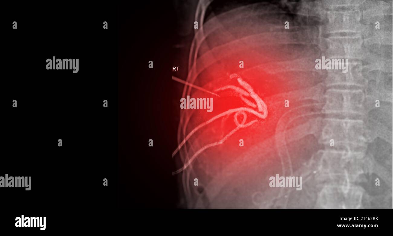 Percutaneous Transhepatic Biliary Drainage (PTBD) is a medical ... Percutaneous Transhepatic Biliary Drainage (PTBD) is a medical ...