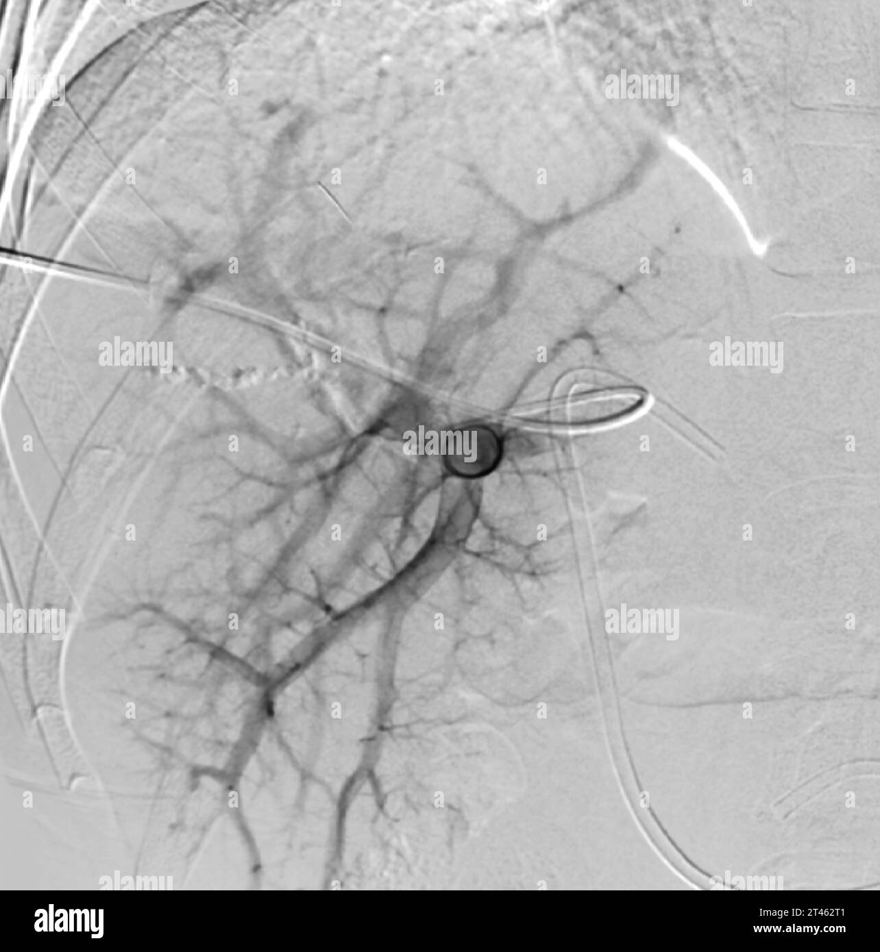 Portal Vein Embolization (PVE) is a medical procedure used to remaining ...