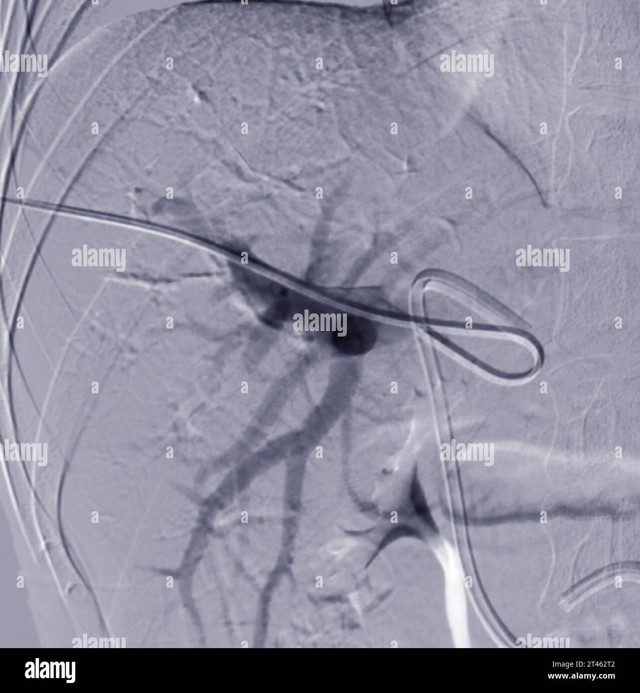 Portal vein embolization hi-res stock photography and images - Alamy