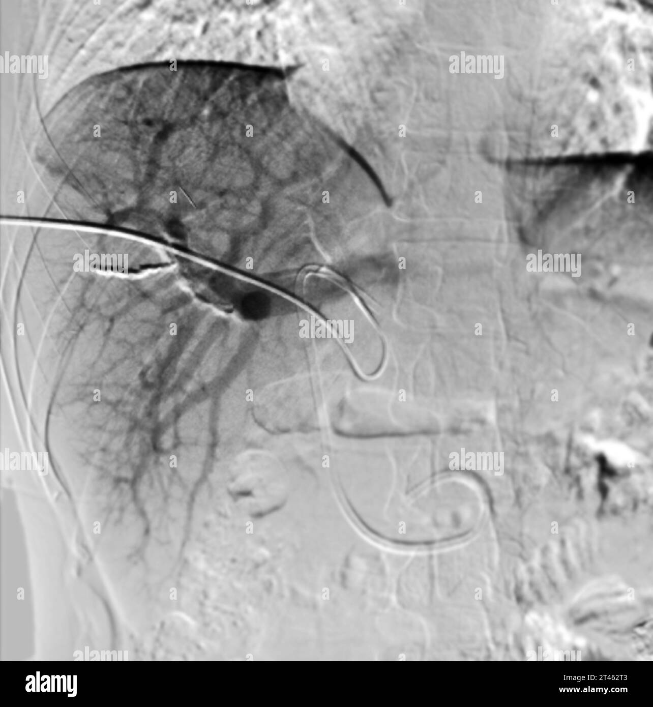 Portal Vein Embolization (PVE) is a medical procedure used to remaining ...