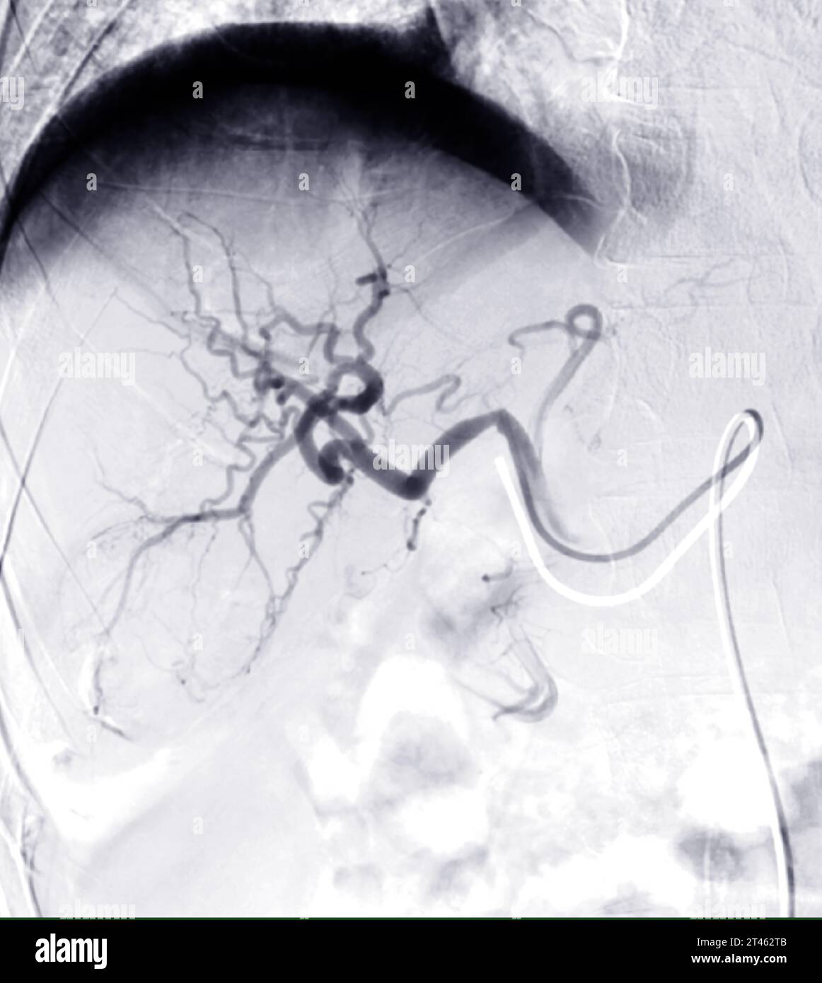 Transarterial Chemoembolization (TACE) is a medical procedure used to ...