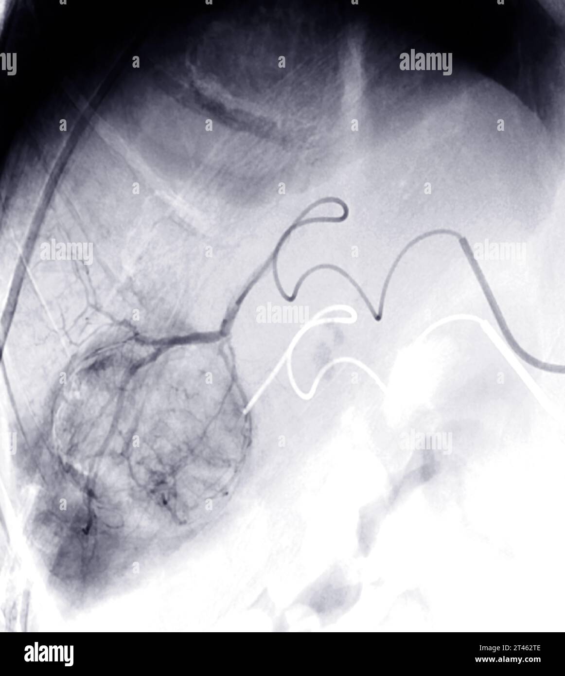 Transarterial Chemoembolization (TACE) is a medical procedure used to ...