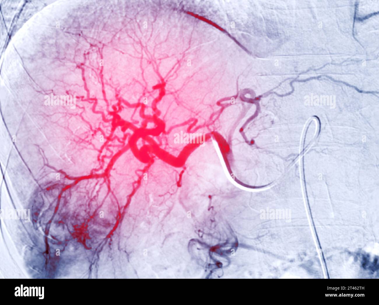 Transarterial Chemoembolization (TACE) is a medical procedure used to ...