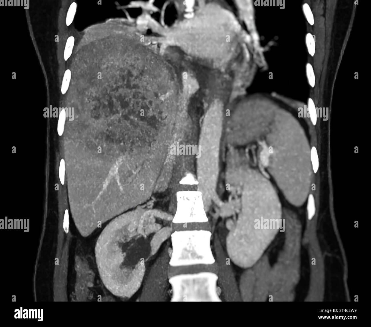 Abdominal Ct Coronal View